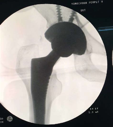 China Hip Joint Adc Acetabular Liner Manufacturer And Supplier Zath