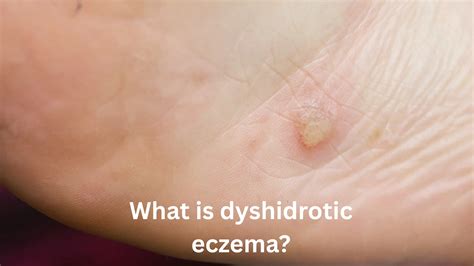 What Is Dyshidrotic Eczema Causes Symptoms And Treatment