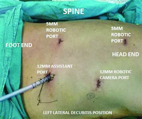 Robotic Assisted Transthoracic Esophageal Diverticulectomy Pmc