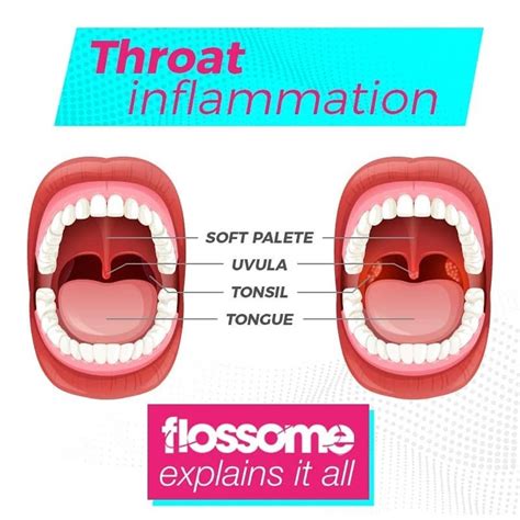 Bacterial Infection On Tongue