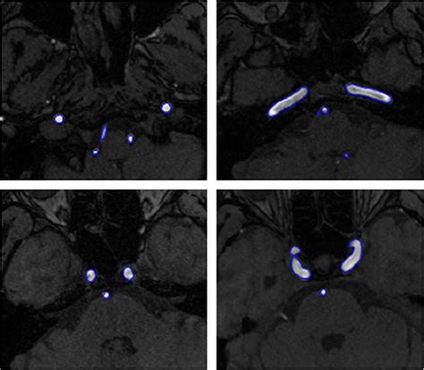 Some 2d Slices Of The Segmentation Result On Cerebral Mra Dataset Using