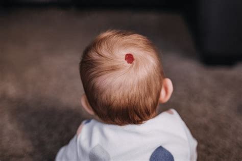 Cute Birthmark