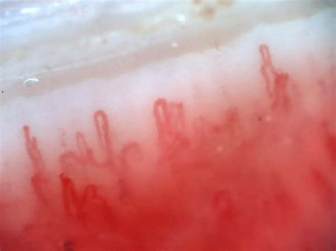 Ssc Capillaroscopy Image Nail Bed With Dilated Capillaries And Areas