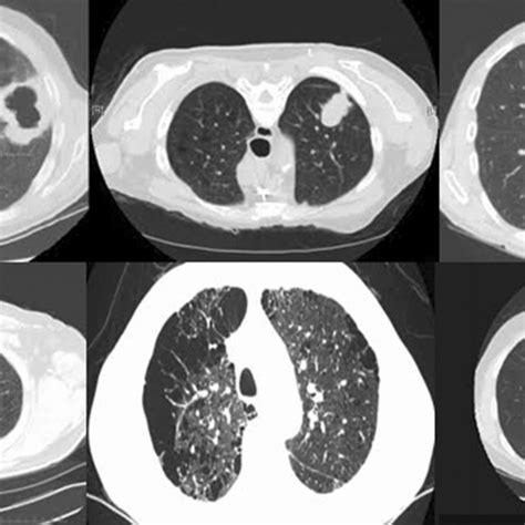 Improved Deep Neural Network And Ensemble Classifier Based Lung Cancer Download Scientific