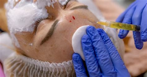 Three Women Infected With Hiv After Getting Vampire Facials At