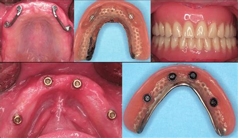 Implant Supported Dentures Maxillary