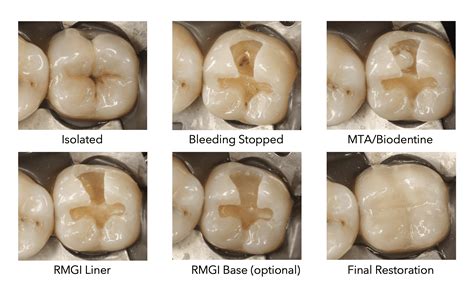Pdf Success Of Direct Pulp Capping And Partial Pulpotomy 54 Off