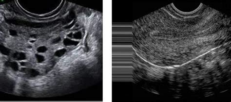 Overview Of Dataset A Left Image Is A Polycystic Ovarian Ultrasound