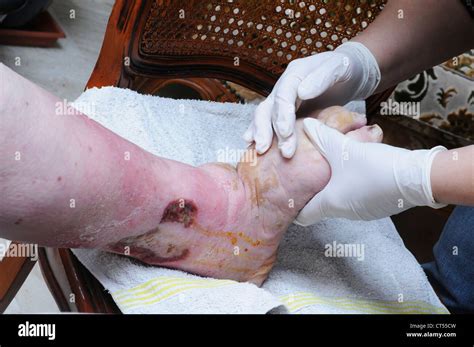 LEG ULCERS CARE Stock Photo Alamy