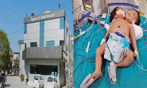 Amazing Conjoined Twins In Haryana Have A Single Body With Two Heads