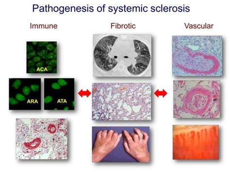 The State Of Scleroderma Clinical Trials Pptx