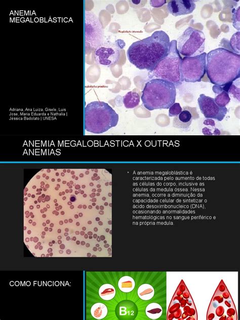 Anemia Megaloblástica Pdf Anemia Especialidades Médicas