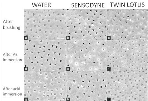 Scanning Electron Microscopy Of Dentine Surfaces After Brushing A‑c