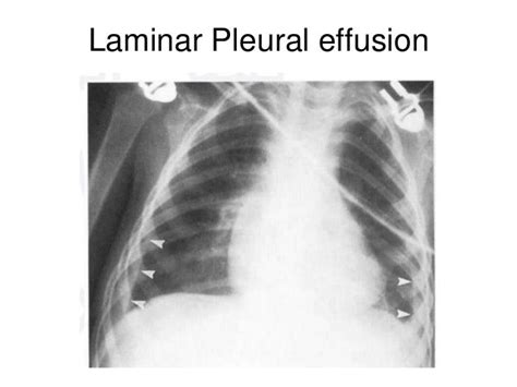 Pleural Effusion Dr Mahesh