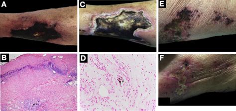 Cirrhosis Presenting As Cutaneous Calciphylaxis Clinical