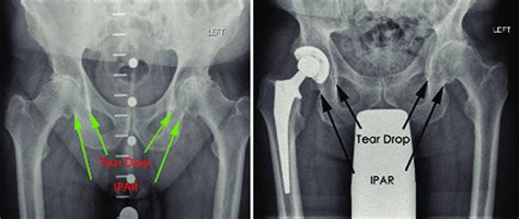 X Ray Pelvis With Both Hip Joints And Proximal 13 Rd Of Femur Download Scientific Diagram