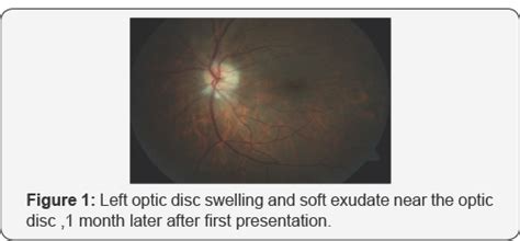A Case Of Temporal Arteritis Associated With Atypical Clinical Findings Juniper Publishers U