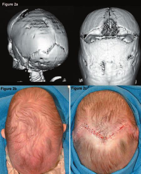 A Three Dimensional Reconstruction Of A Ct Scan Demonstrating
