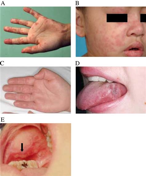 Urticarial Vasculitis Face