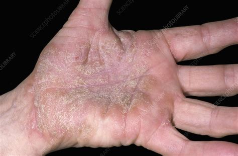 Palmar Keratoderma On The Hand Stock Image C0494400 Science
