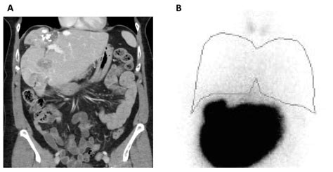 A Patient With Multifocal Right Sided Intrahepatic Cholangiocarcinoma Download Scientific