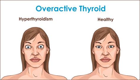 Royalty Free Hyperthyroidism Clip Art Vector Images And Illustrations Istock
