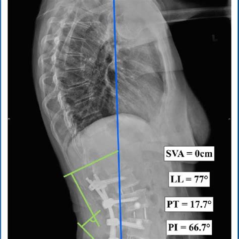 Pdf Anterior Longitudinal Ligament Release From The Minimally Invasive Lateral Retroperitoneal