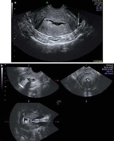 What Is Myometrial Echo Pattern Radiology