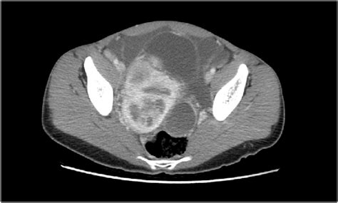Ct Of Abdomen And Pelvis Revealing Abdominal Ascites Nodularity Of The