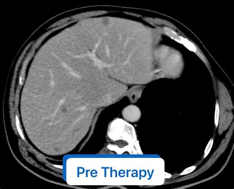Sinusoidal Obstruction Syndrome Sos Chemoradiotherapy Can Impact The