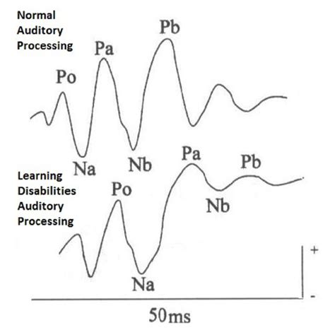 Auditory Middle Latency Responses Amlr Traces Normal Processing ×