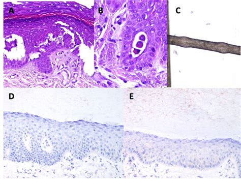 Figure 1 From Heterozygous Arrhythmogenic Cardiomyopathy Desmoplakin
