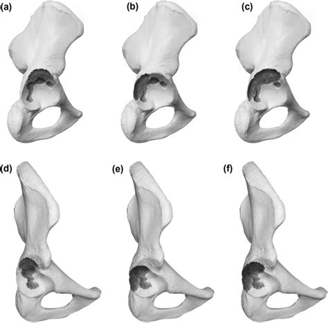 Af Acetabular Defect Classification Adc Type 2 A Lateral View Of A