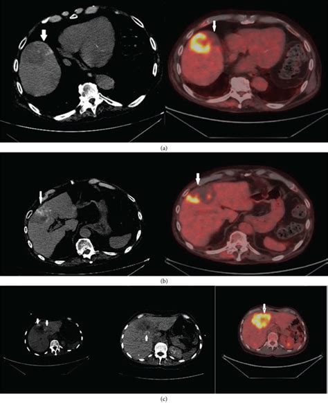 A B The Column On The Left Demonstrates Post Embolization Contrast Download Scientific