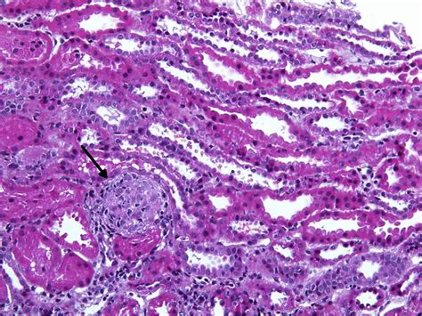 Renal Biopsy Sample B Noncaseating Granuloma Arrow In The