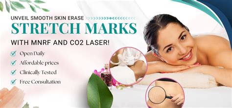 Stretch Marks Removal Treatment In Jalandhar
