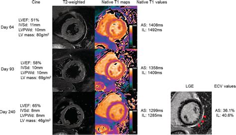 Serial Cardiac Magnetic Resonance Imaging Lvef And Lv Mass Measured Download Scientific