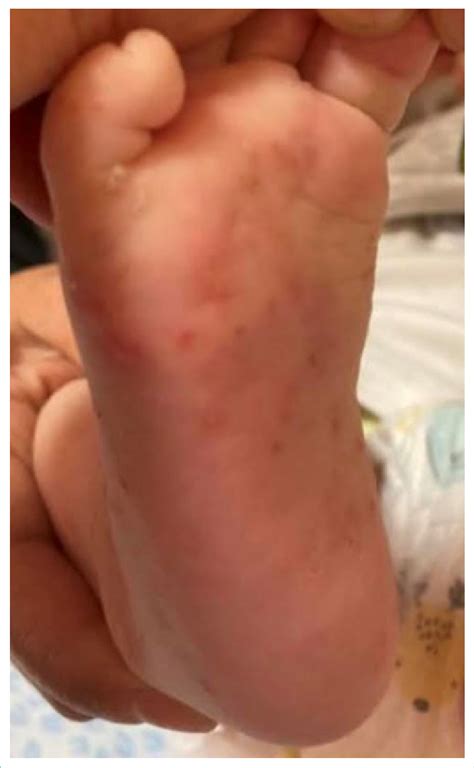 Vesiculopustular Lesion On The Sole Of A Patient Diagnosed With Download Scientific Diagram