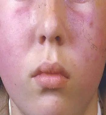 Skin Rash As The Initial Manifestation Of Systemic Rheumatic Disease