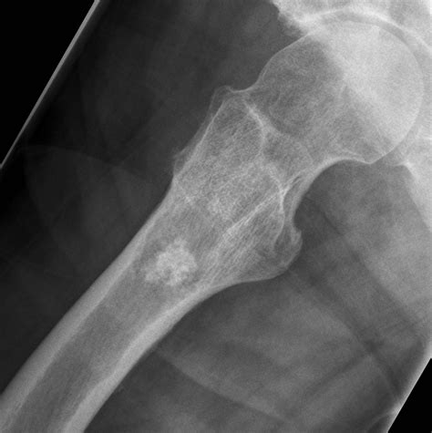 Chondrosarcoma Proximal Femur Image