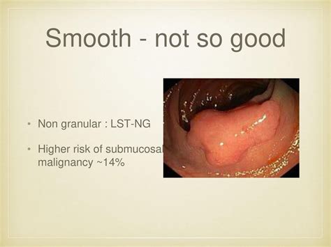 Endoscopic Morphology Of Colorectal Polyps Ppt Download Endoscopic Morphology Of Colorectal Polyps Ppt Download