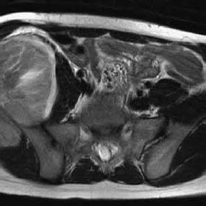 Signal Intensity On T2 Weighted Images Axial T2 Weighted Image Of The Download Scientific