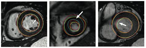 lv segmentation challenge cardiac atlas project