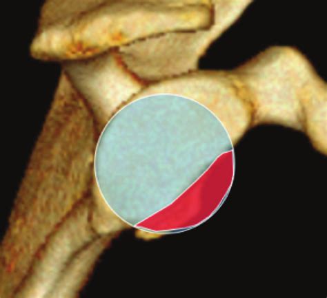 En Face View And Conserved Circle With Absent Glenoid Bone Highlighted