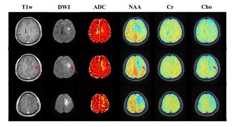 Representative Diffusion Images Including Diffusion Weighted Image And Download Scientific