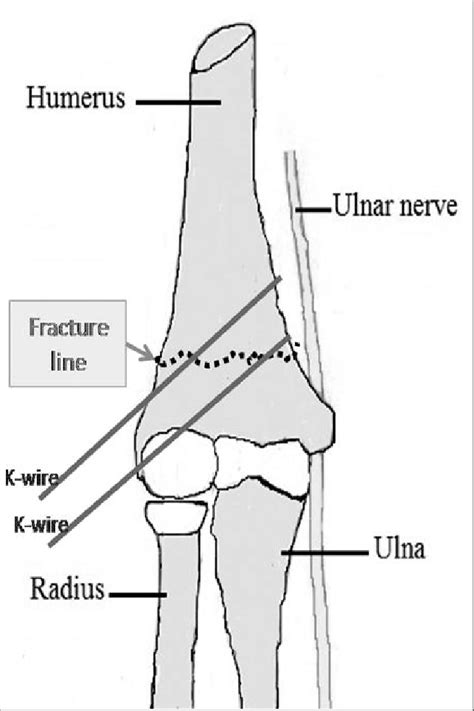 Fixation Of Fracture Fragment By Two Lateral Kwire Download Scientific Diagram