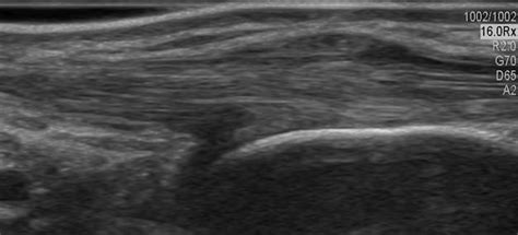 Musculoskeletal Joints And Tendons 6 3 Wrist And Carpus Case 6 3 1 Tenosynovitis Of The