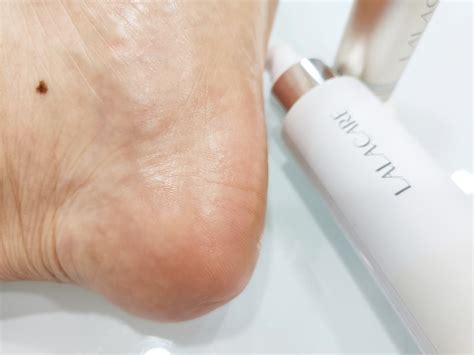 발뒤꿈치 갈라짐 발바닥 굳은살 제거 편한 랄라케어 각질앤 발각질제거기 네이버 블로그