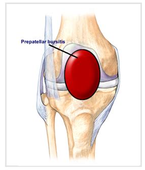 Prepatellar Bursitis Natural Treatment Osmo Patch Uk