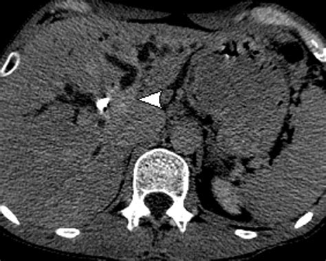 Liver Atlas Case 20 Cholangiocarcinoma